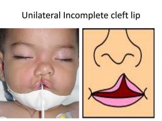 CLEFT LIP AND CLEFT PALATE PPT.pptx child | PPTX