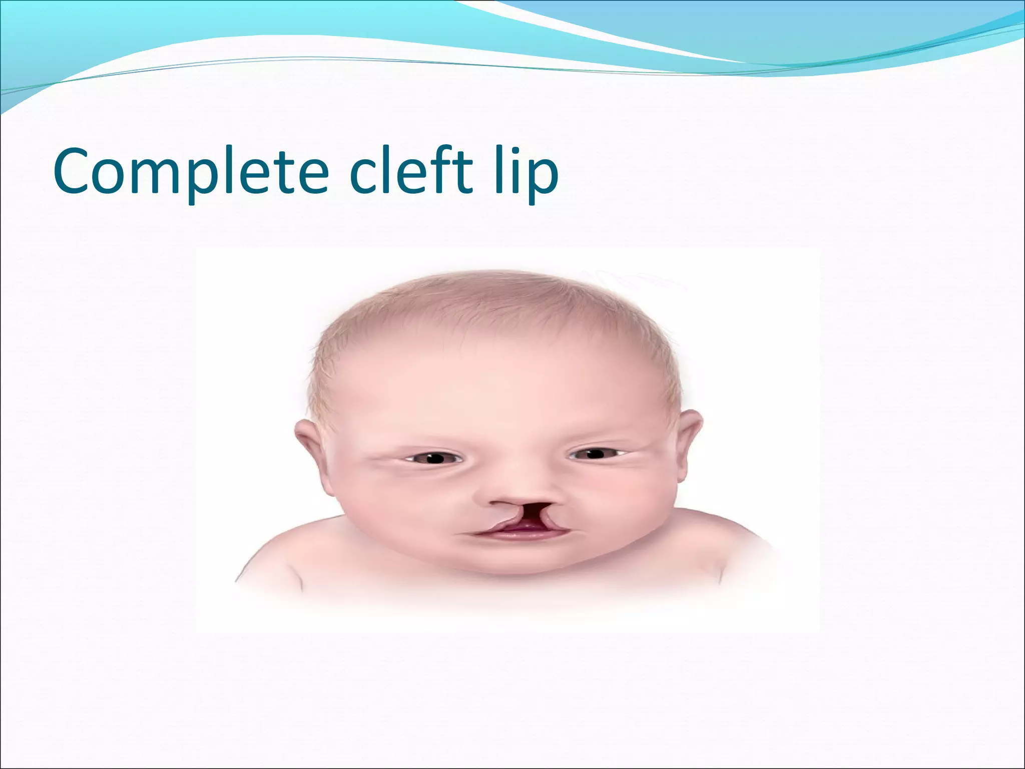 Cleft Lip & Cleft Palate | PPT