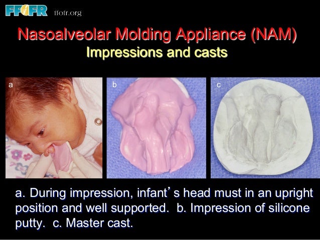 Cleft lip and palate