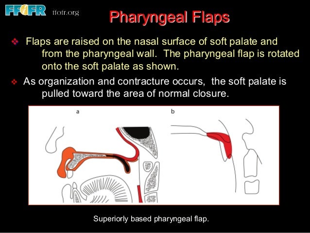 Cleft lip and palate