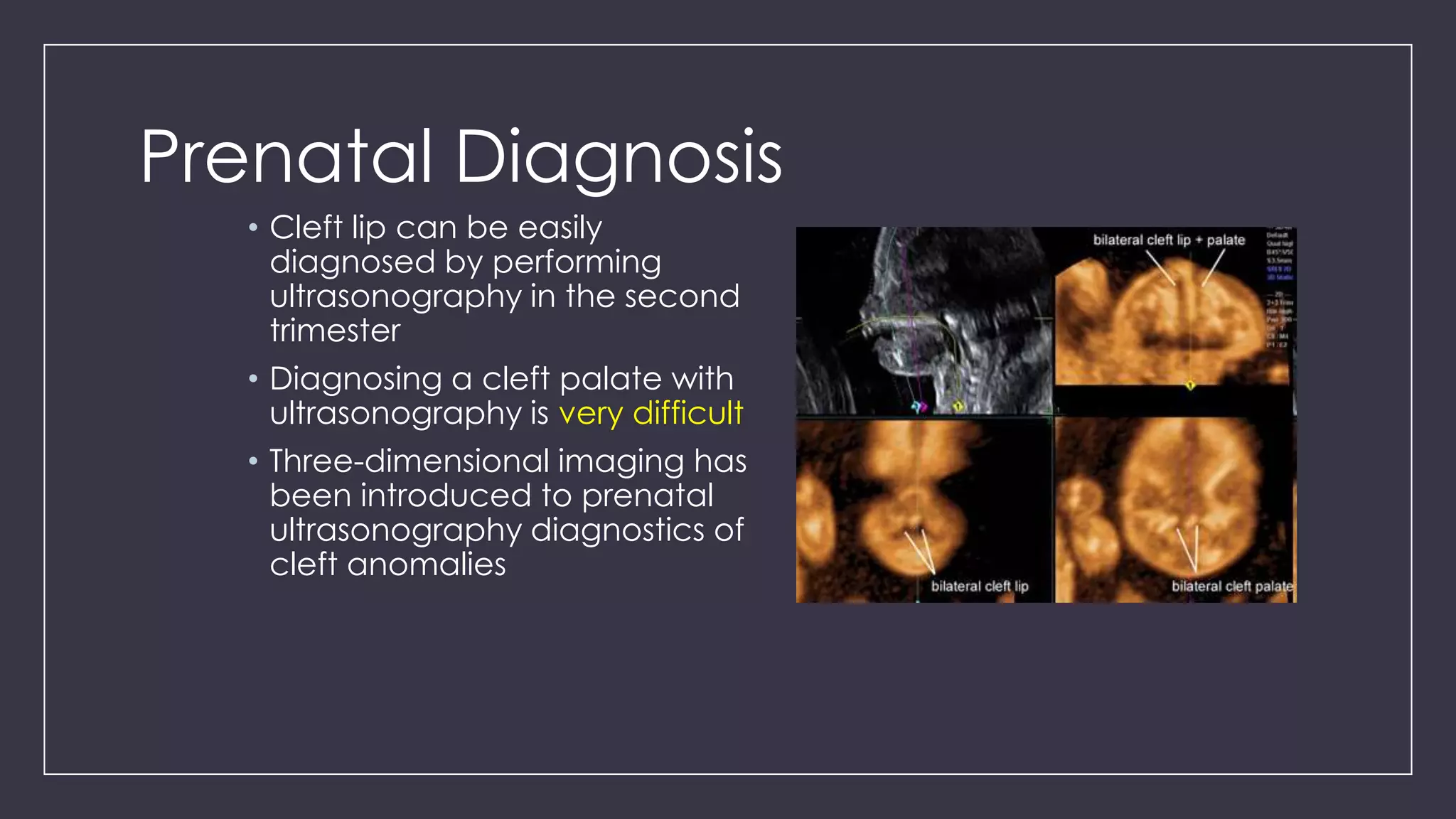Cleft lip and palate | PPTX