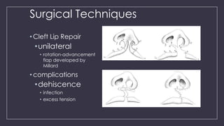 Cleft lip and palate | PPTX