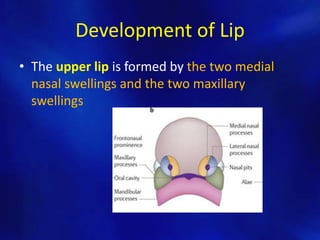 Cleft lip and palate | PPTX