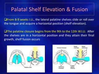 Cleft lip and palate | PPTX