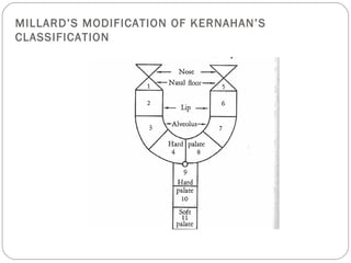 Cleftlipandpalate | PPT