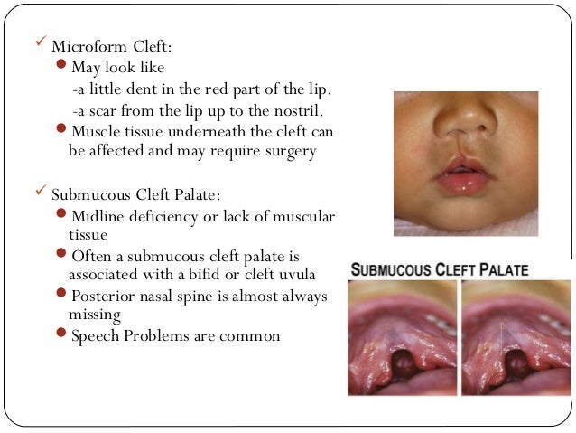 Cleftlipandpalate