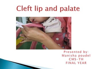 Cleft lip and palate | PPTX