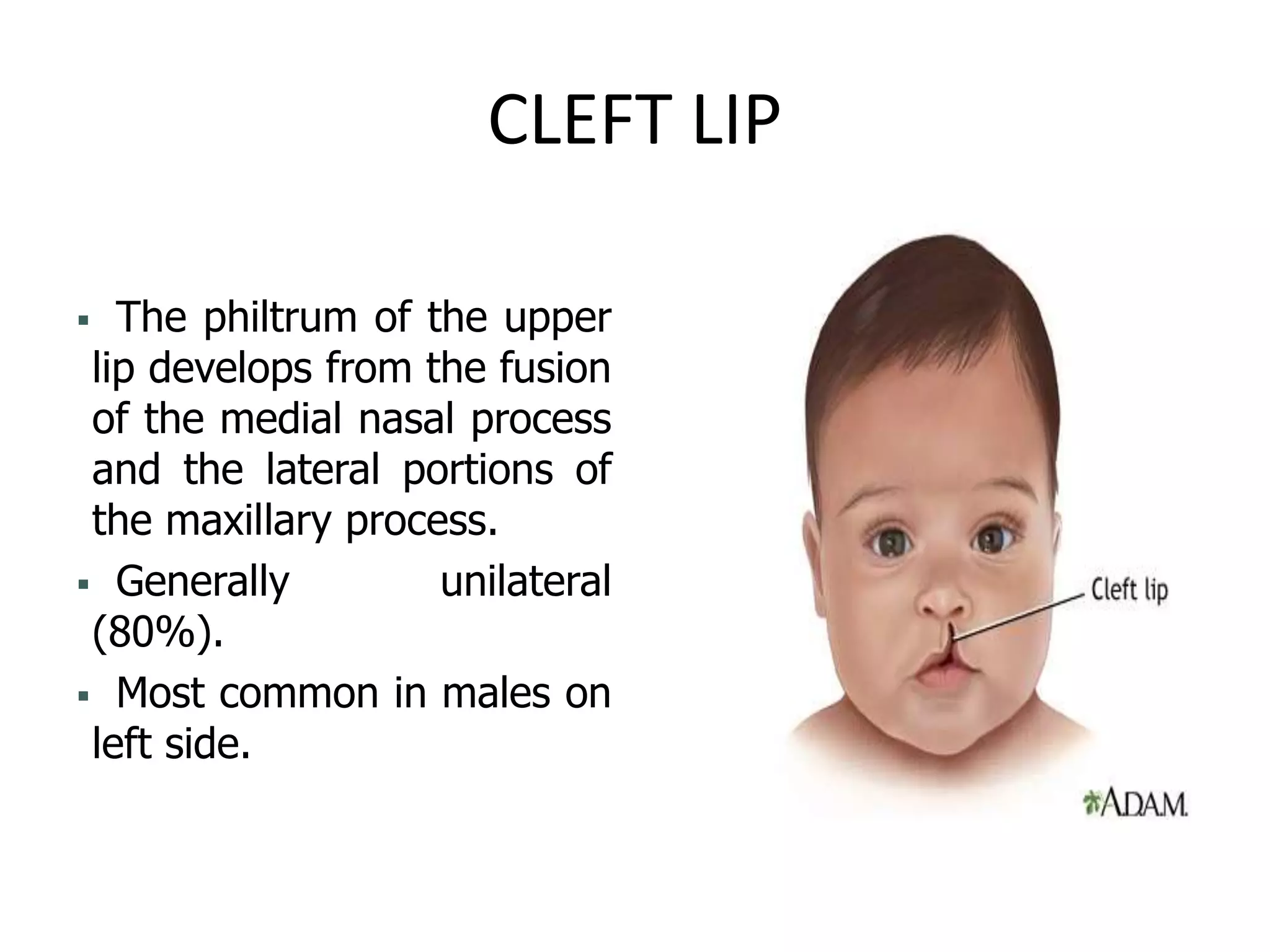 Cleft lip and palate | PPTX