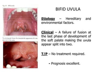 Cleft lip and palate | PPTX