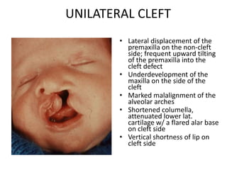 Cleft lip and palate | PPTX