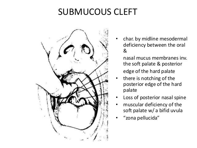 Cleft lip and palate