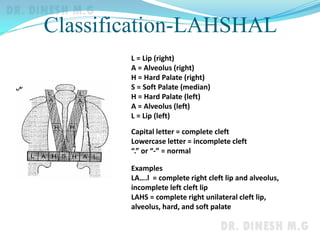 Cleft lip and palate | PPT