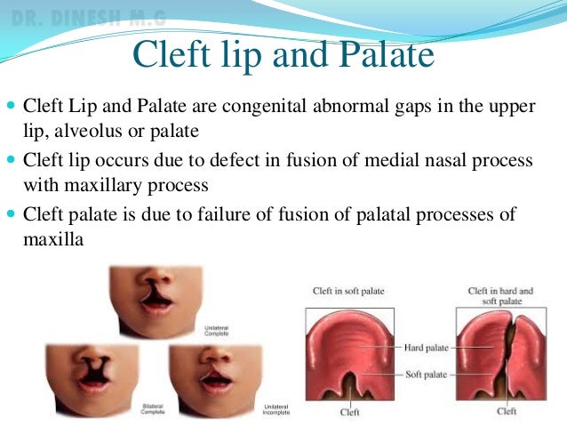 Cleft lip and palate