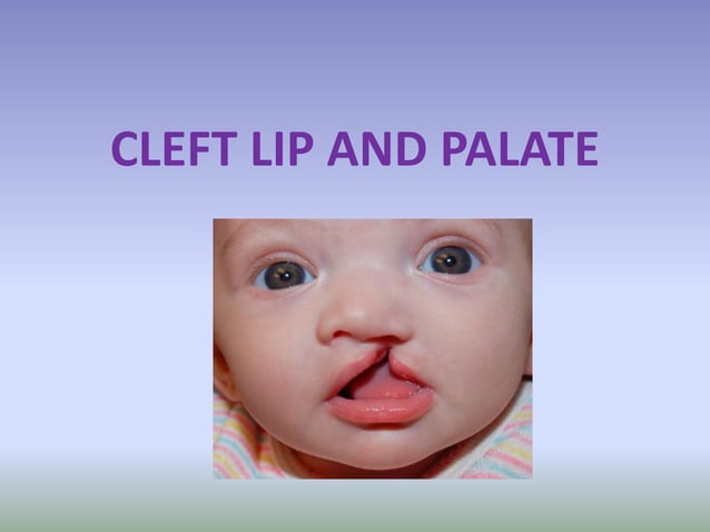 Cleft lip and palate | PPTX
