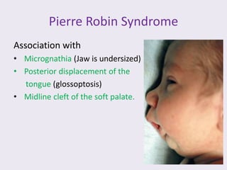 Cleft lip and palate | PPTX
