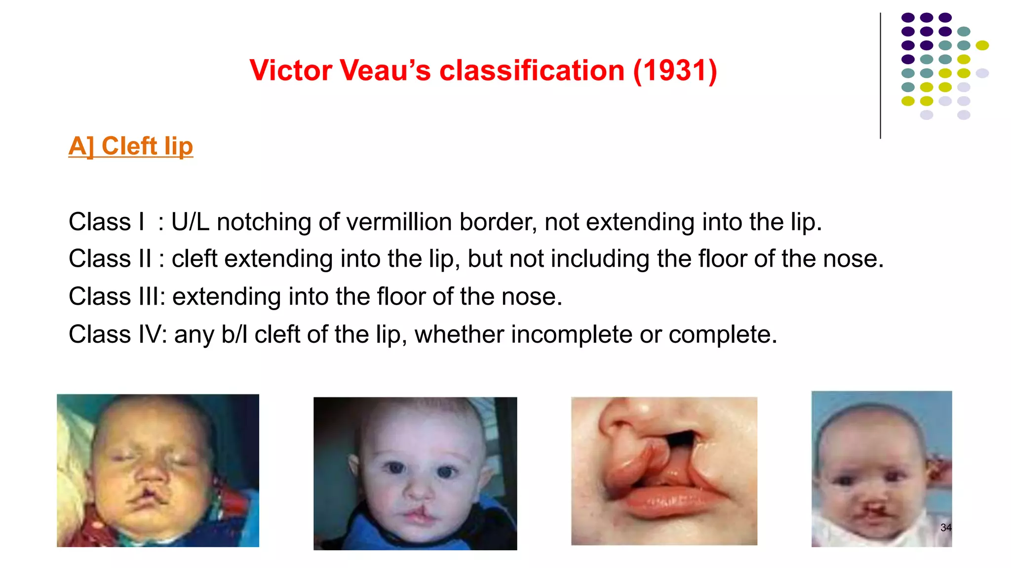 Cleft lip and palate | PPTX