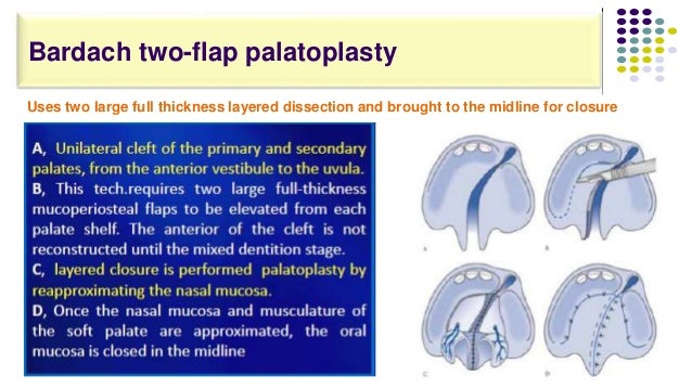 Cleft lip and palate