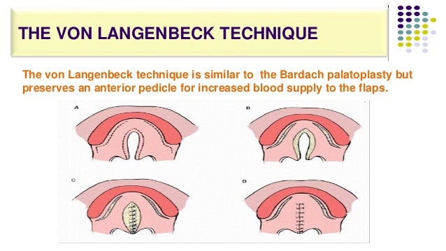 Cleft lip and palate
