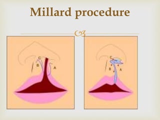 cleftlipandpalate-180613165327.pdf