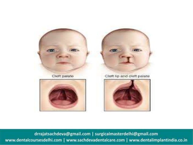 Cleft lip and cleft palate | oral congenital abnormality | oral genet…