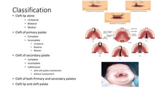 Cleft lip and palate | PPTX
