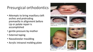 Cleft lip and palate | PPTX