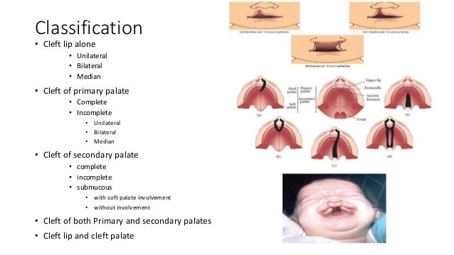 Cleft lip and palate
