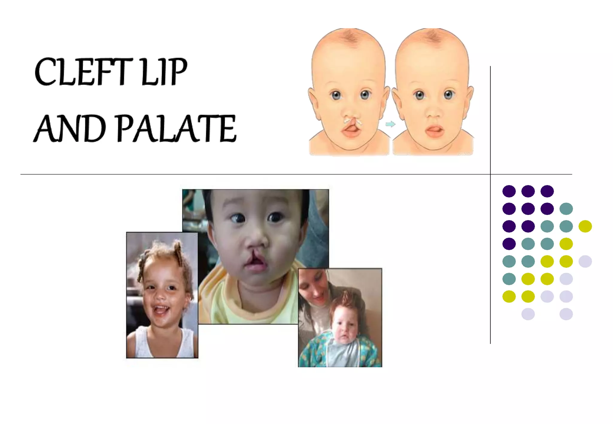 Cleft lip and palate | PPTX | Pregnancy | Reproductive Health