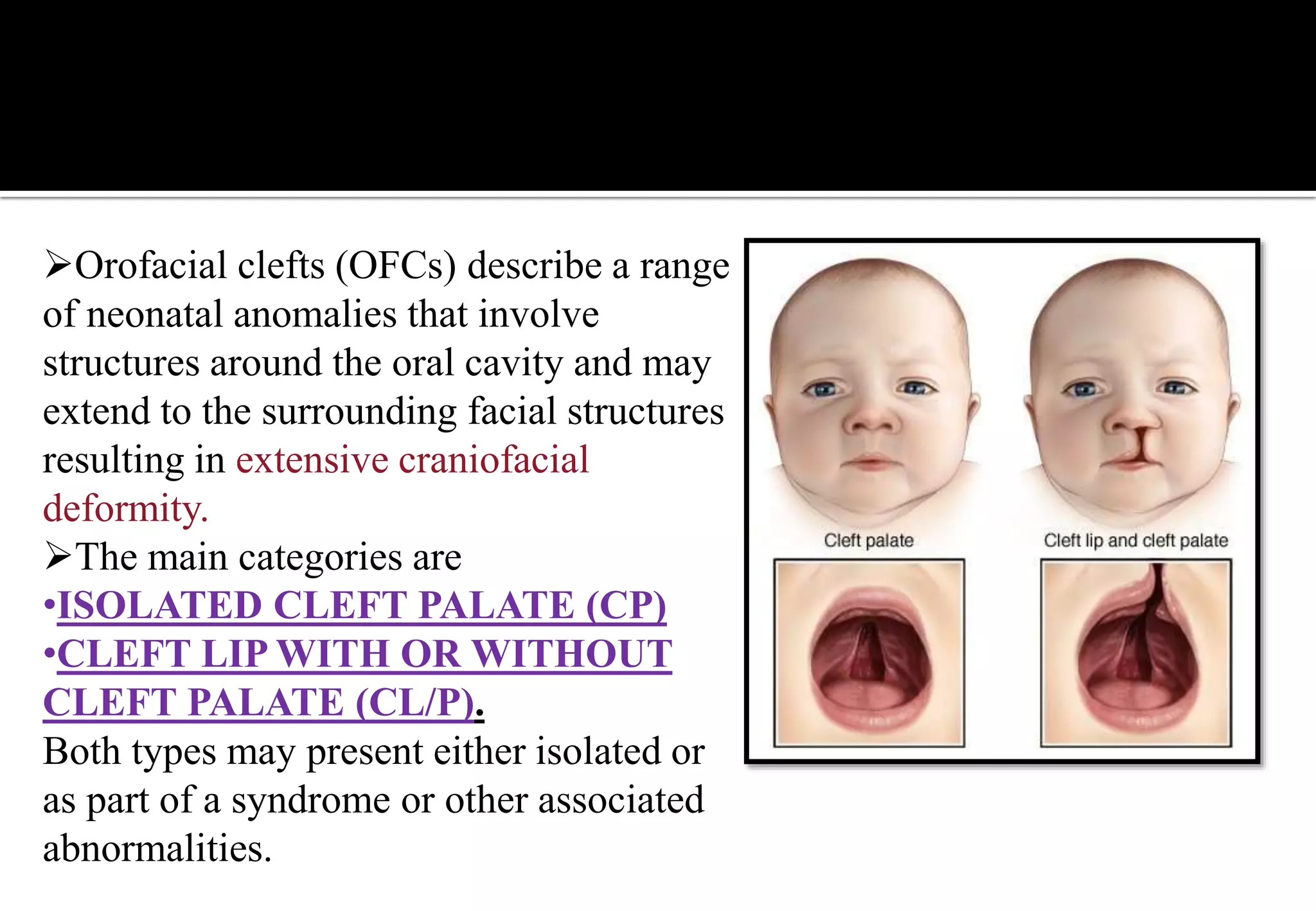 Cleft lip and palate | PPTX | Pregnancy | Reproductive Health