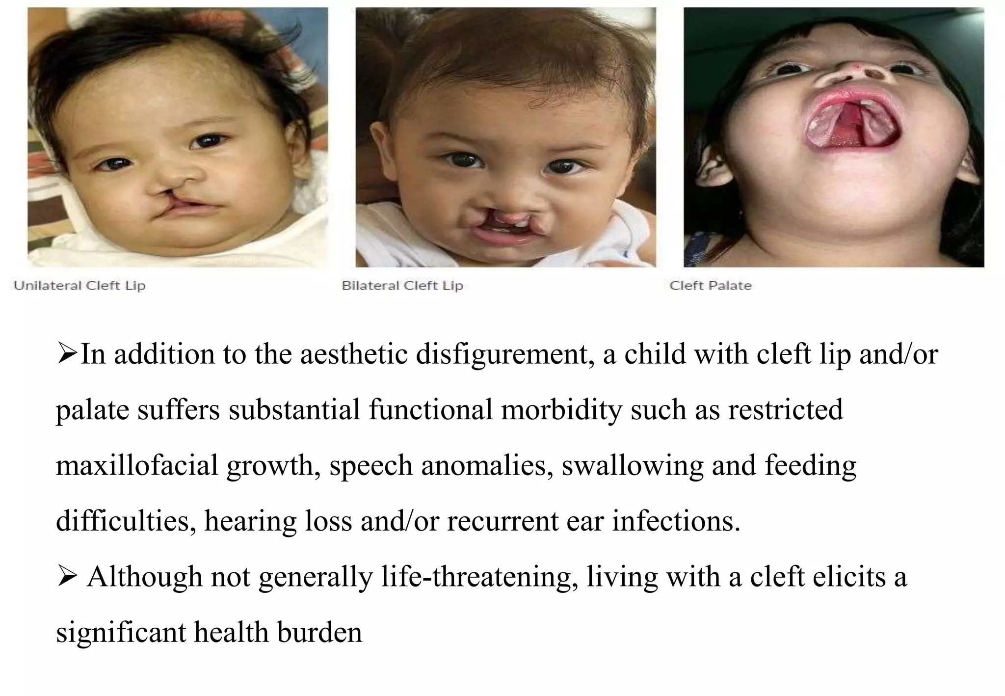 Cleft lip and palate | PPTX | Pregnancy | Reproductive Health