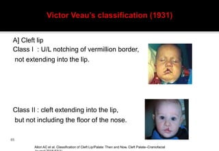 Cleft lip and palate | PPTX