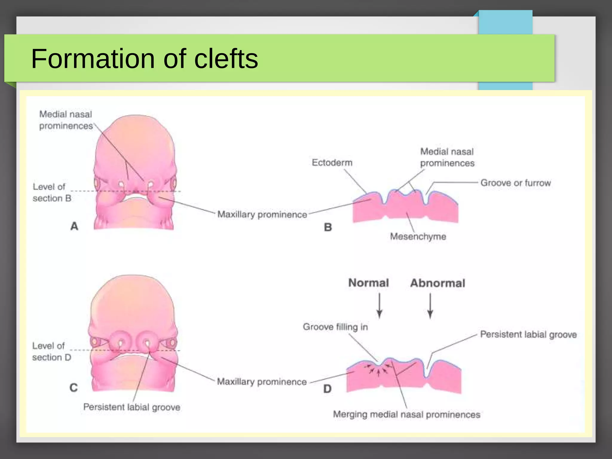 Cleft Lip and Palate | PDF