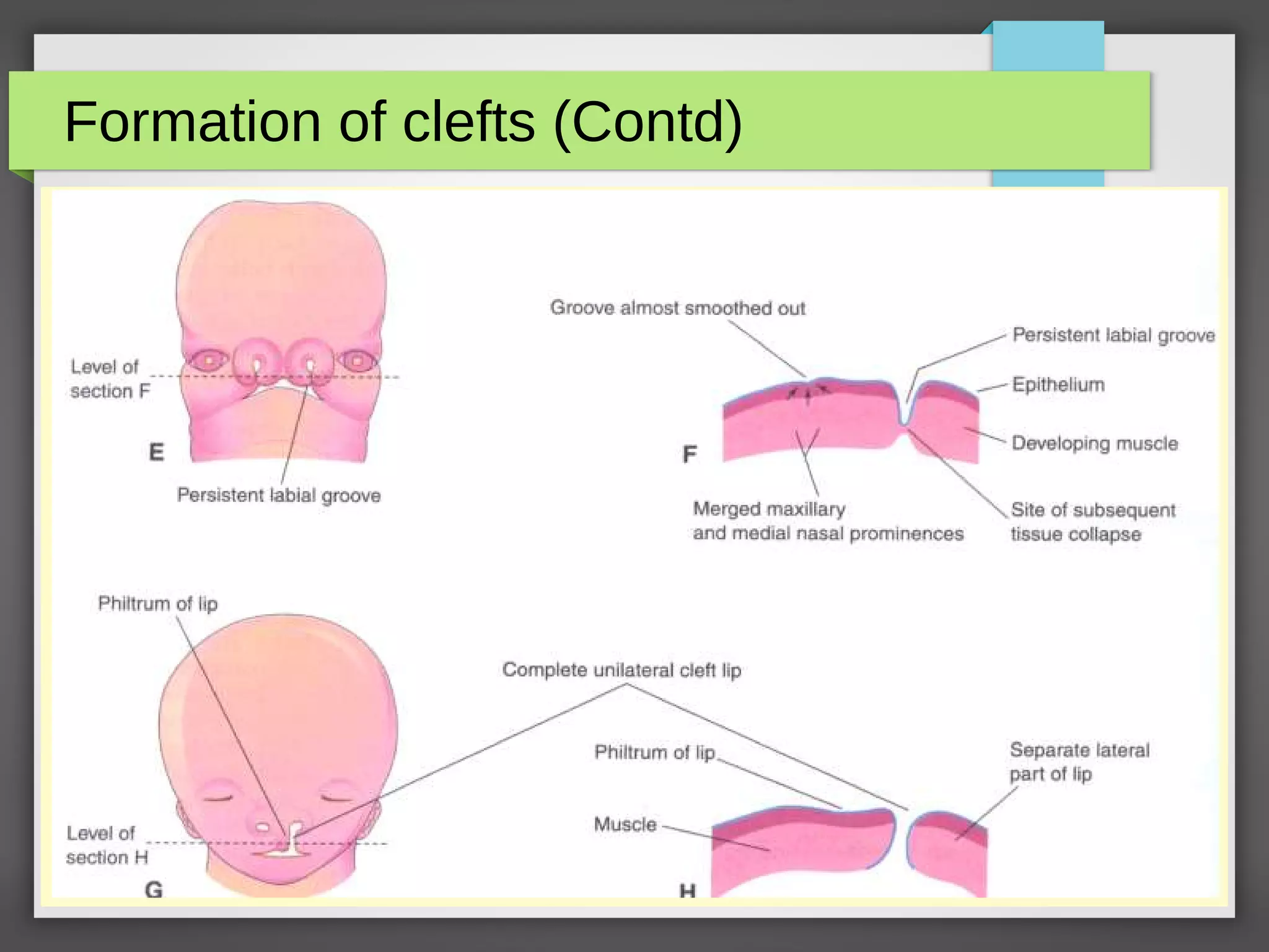 Cleft Lip and Palate | PDF