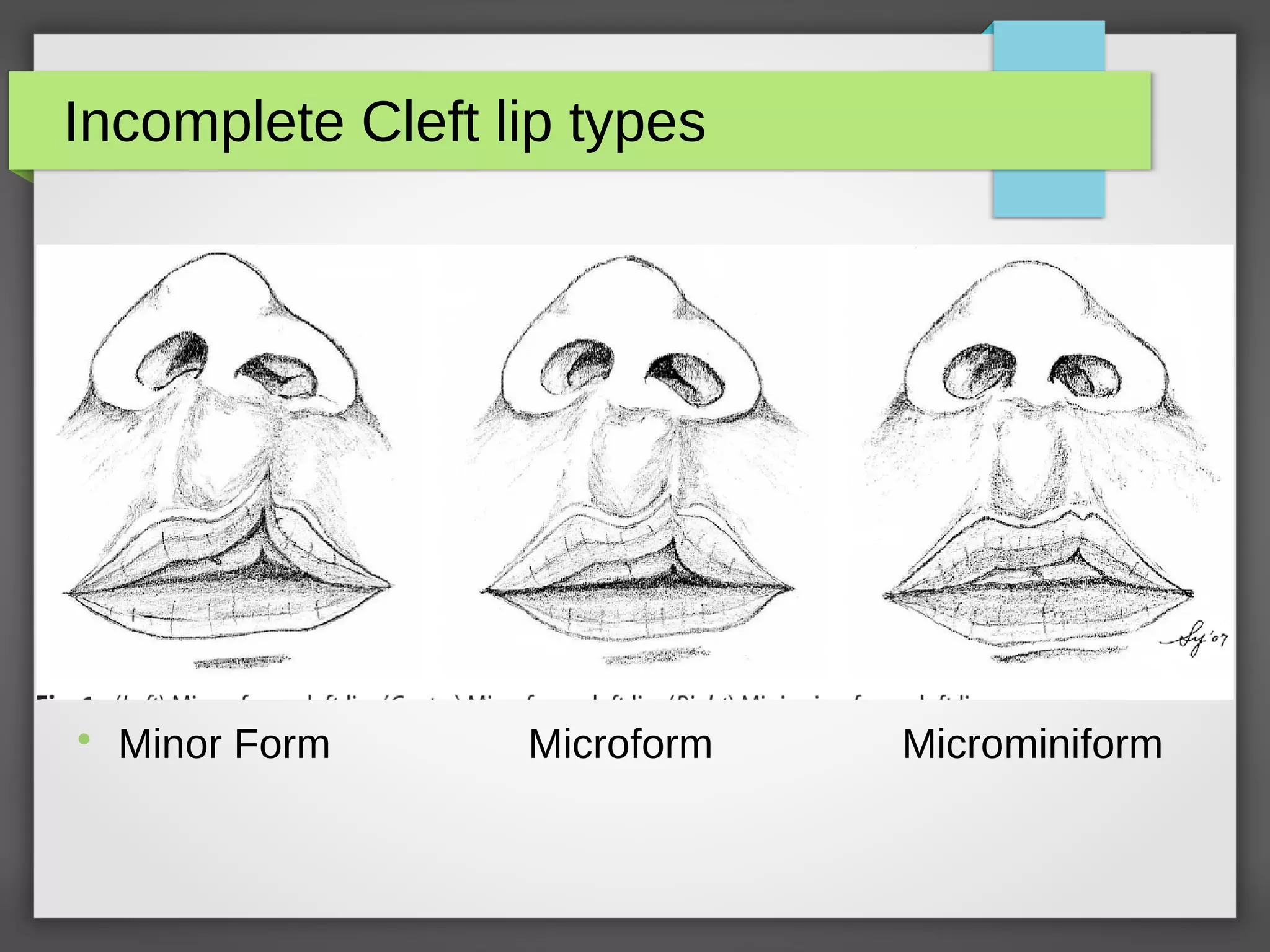 Cleft Lip and Palate | PDF