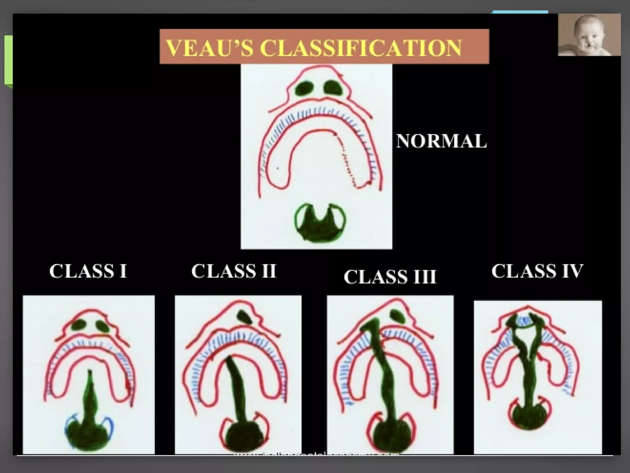 Cleft Lip and Palate | PDF