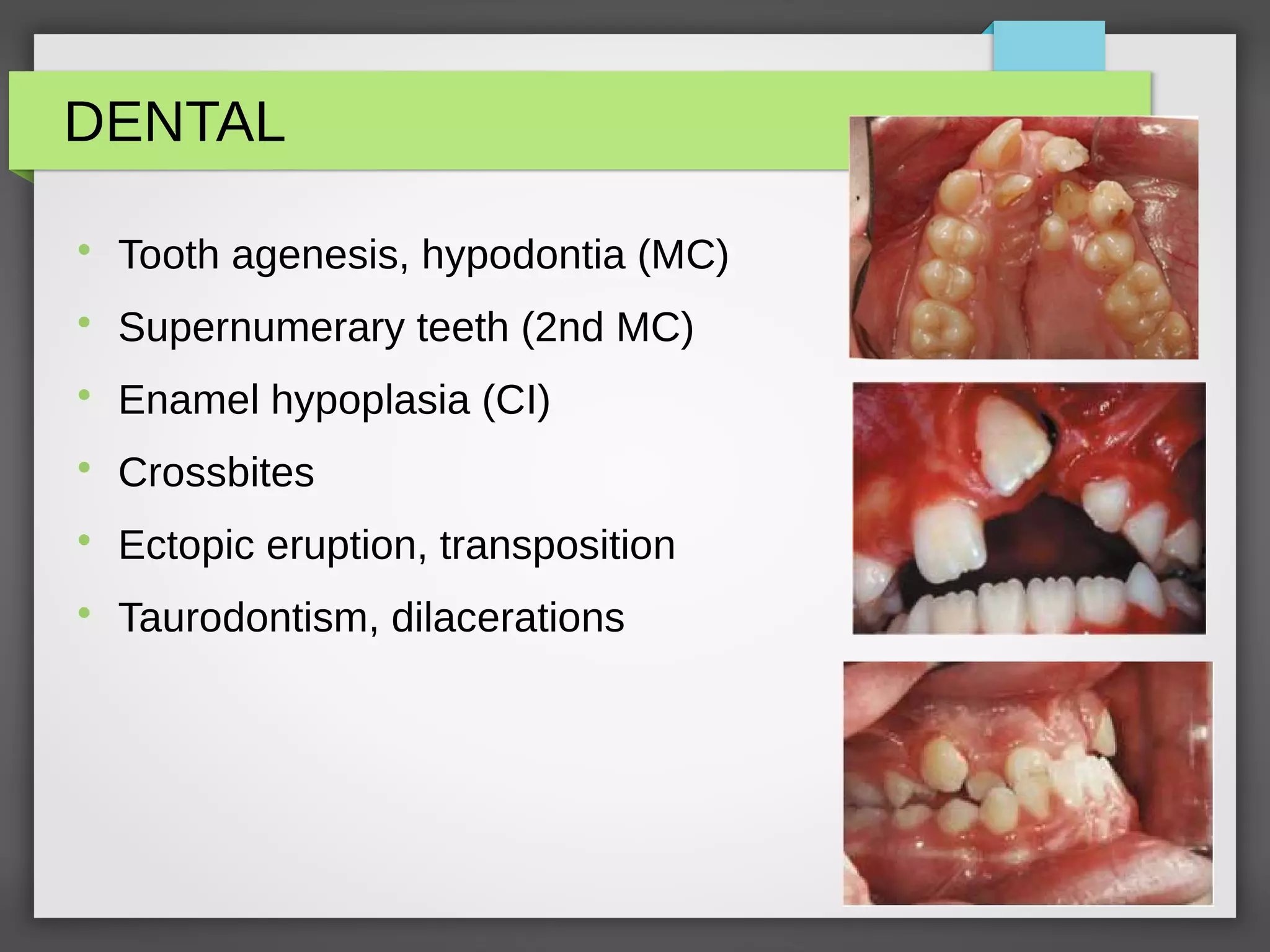 Cleft Lip and Palate | PDF