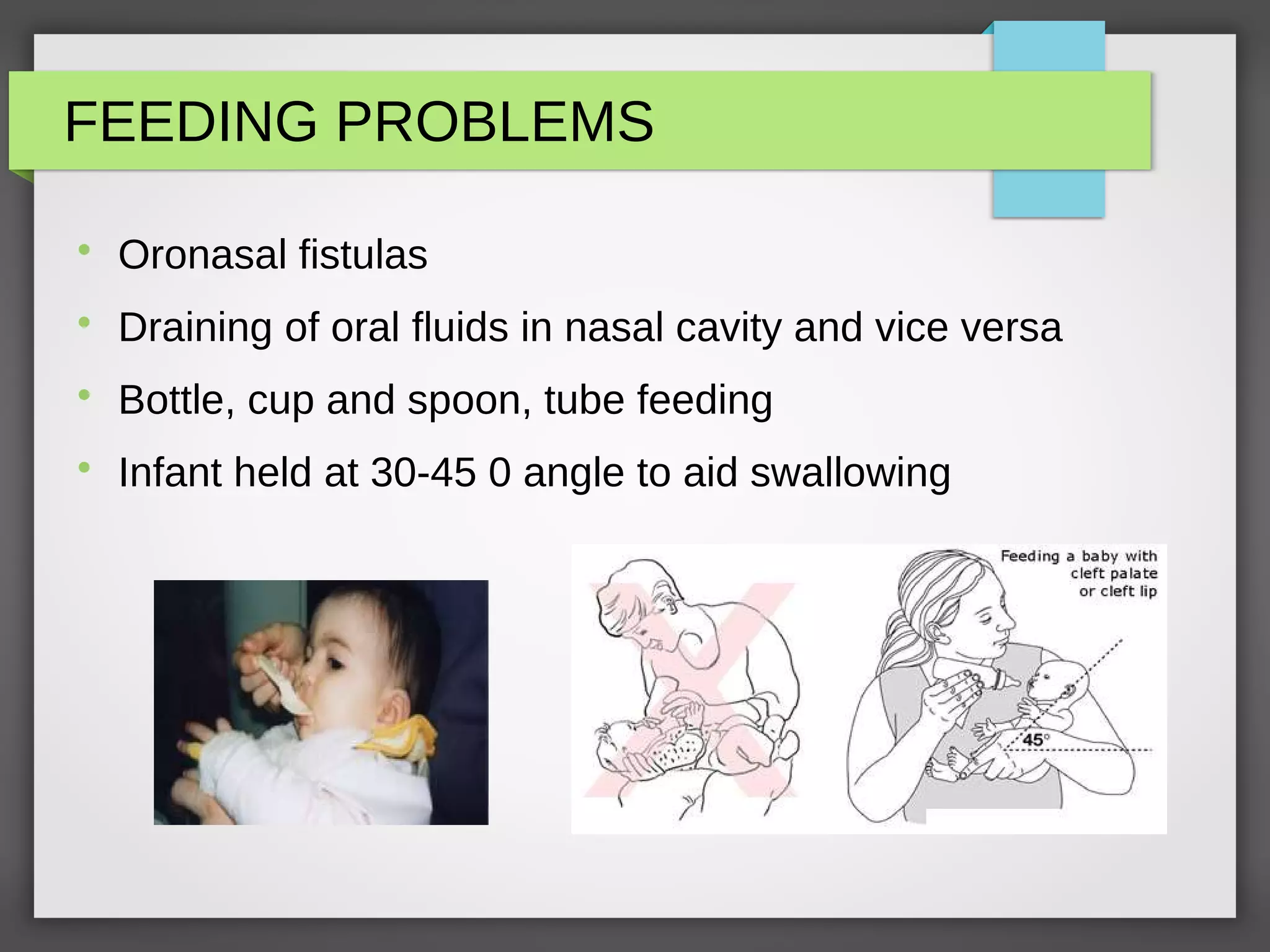 Cleft Lip and Palate | PDF