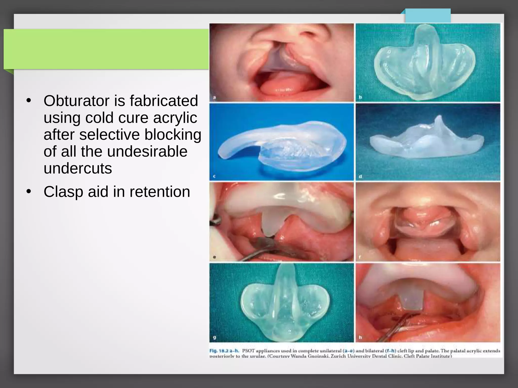 Cleft Lip and Palate | PDF