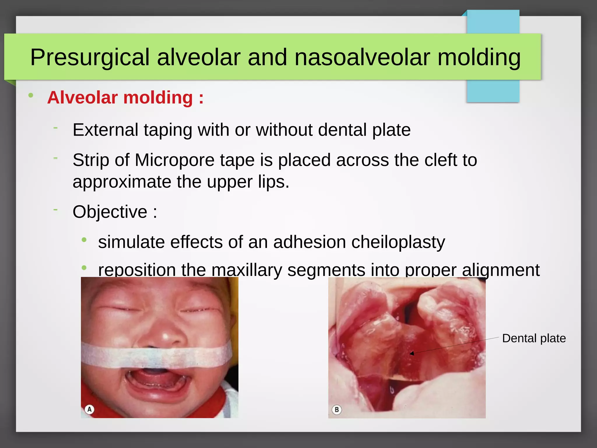 Cleft Lip and Palate | PDF