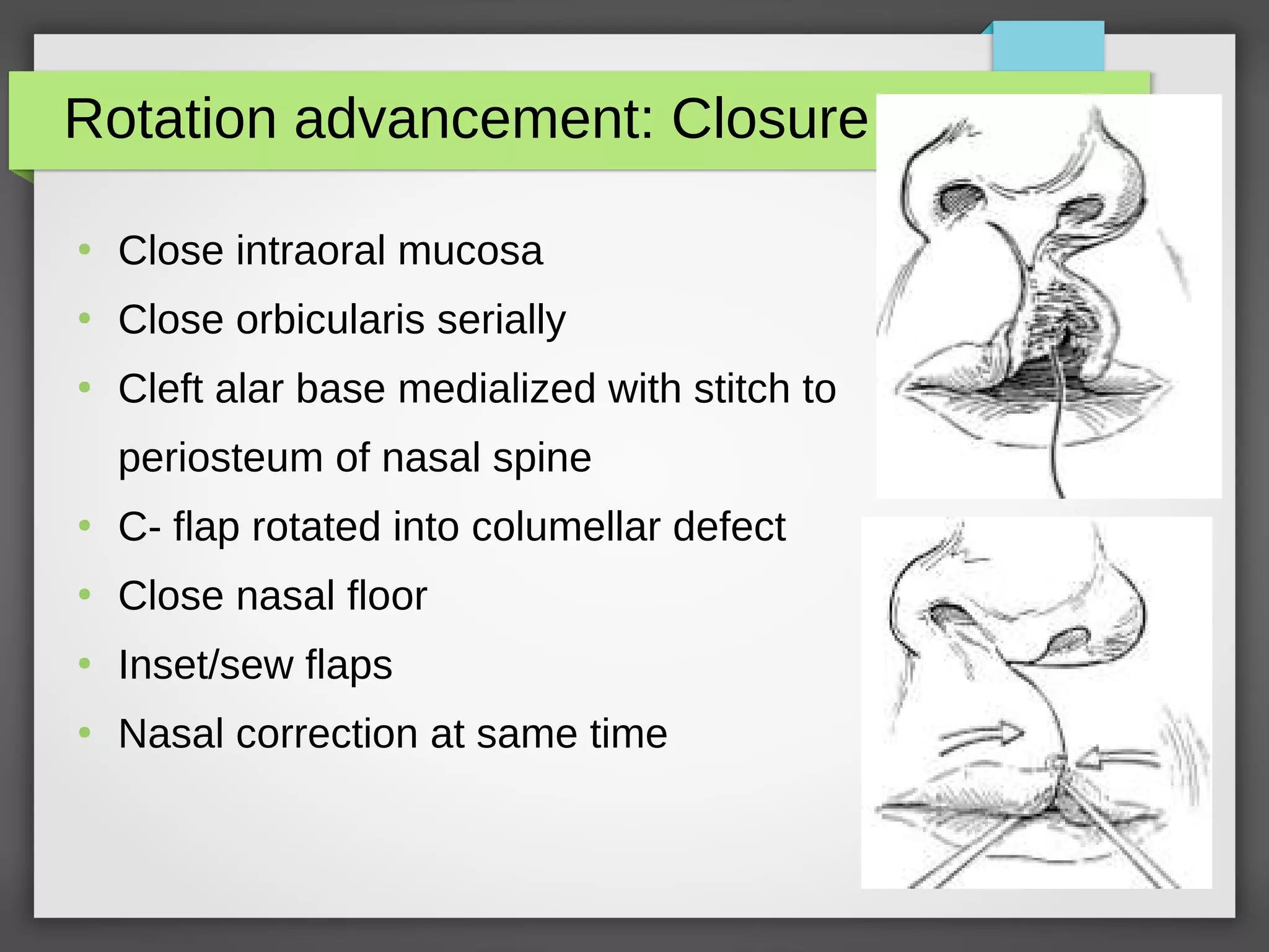 Cleft Lip and Palate | PDF