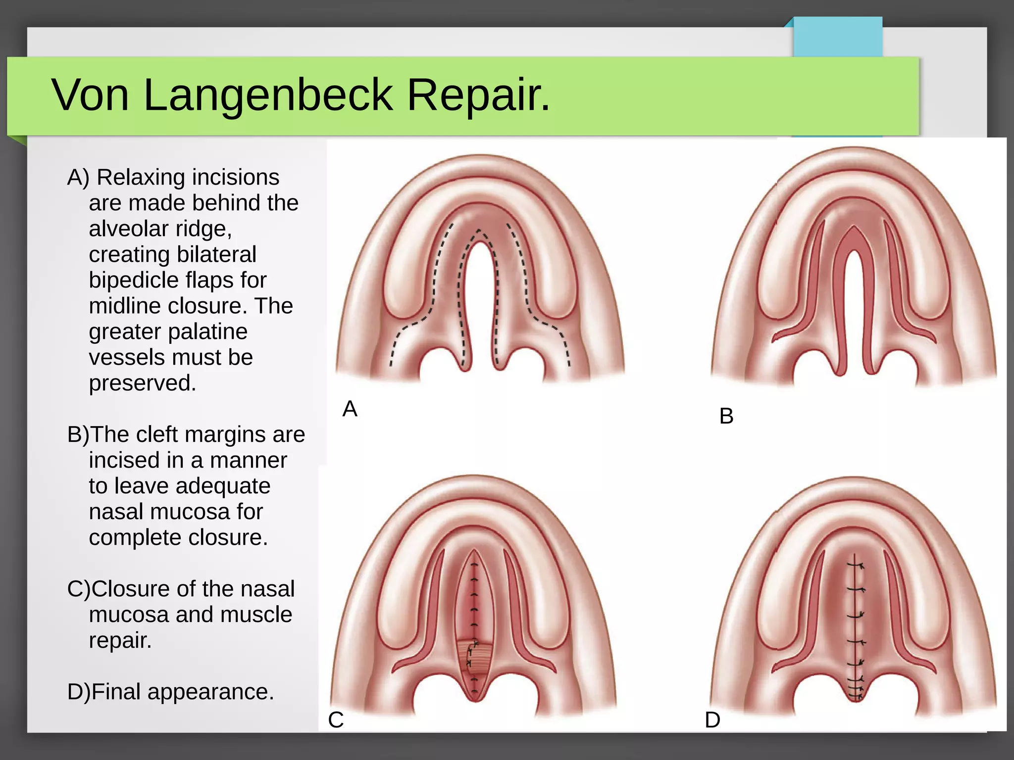 Cleft Lip and Palate | PDF