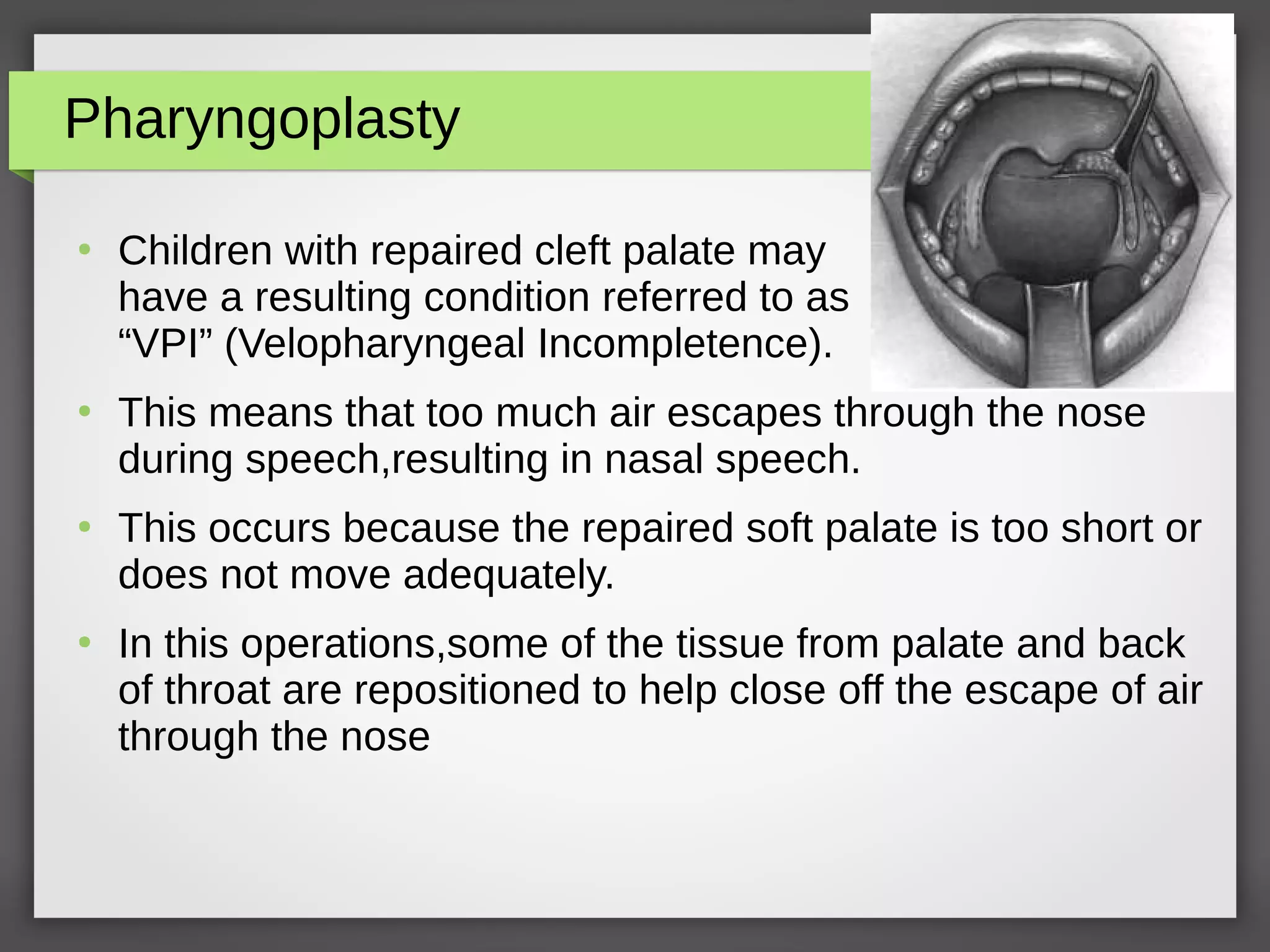 Cleft Lip and Palate | PDF