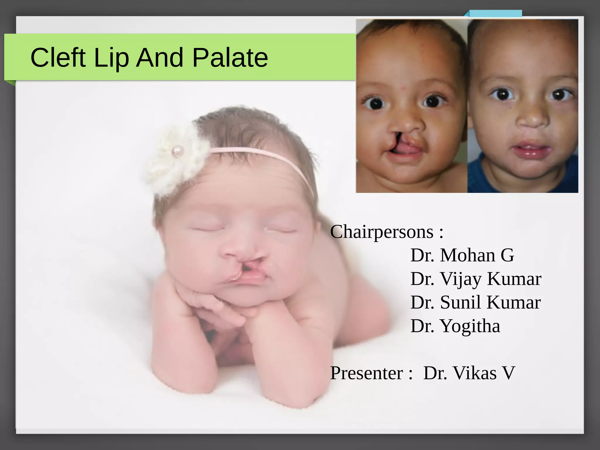 Cleft Lip and Palate | PPT