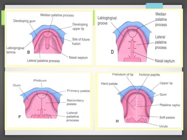 Cleft Lip and Palate | PDF