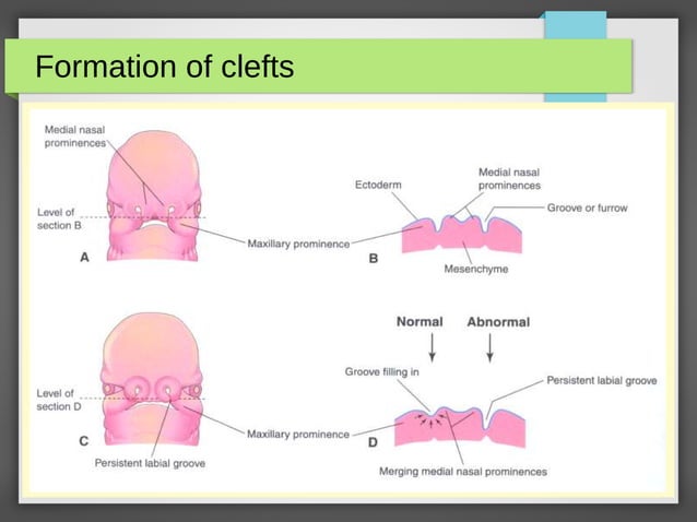 Cleft Lip and Palate | PDF