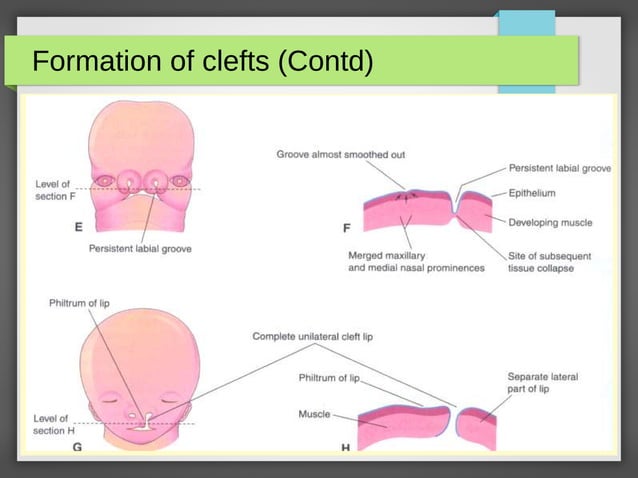 Cleft Lip and Palate | PDF