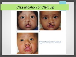 Cleft Lip and Palate | PDF