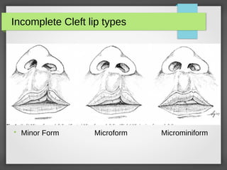 Cleft Lip and Palate | PDF