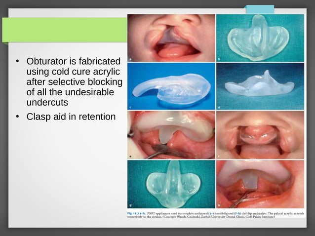 Cleft Lip and Palate | PDF