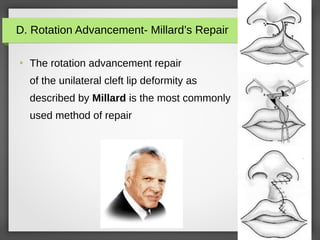 Cleft Lip and Palate | PDF
